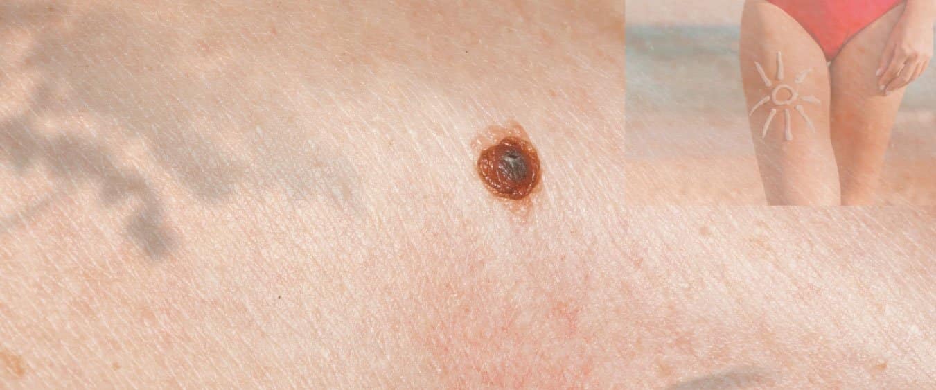 Skin-Cancer-and-Mole-Mapping-min - Capstone Medical Centre Southbank