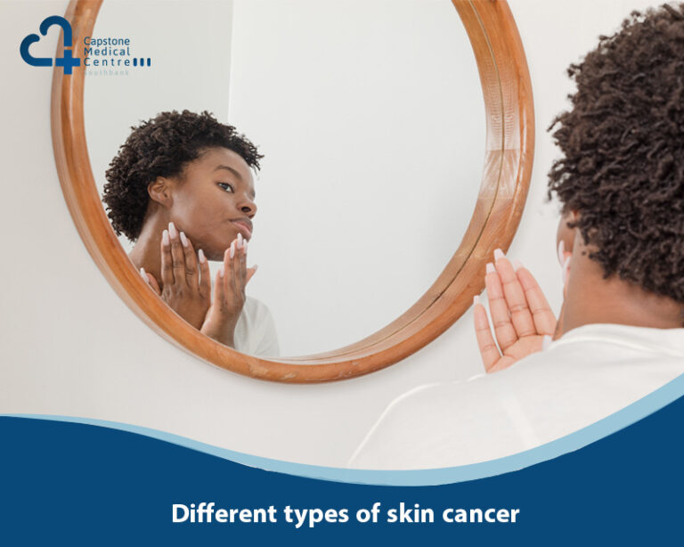 Different types of skin cancer - Capstone Medical Centre Southbank