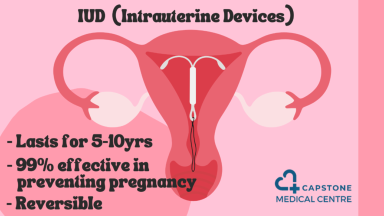 What is IUD? - Capstone Medical Centre Southbank