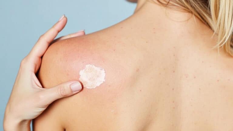 The ABCDEs of Skin Cancer Detection: How to Spot Early? - Capstone ...
